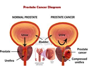 Prostate Infection Medicine in Ghana in Accra Metropolitan - Vitamins ...
